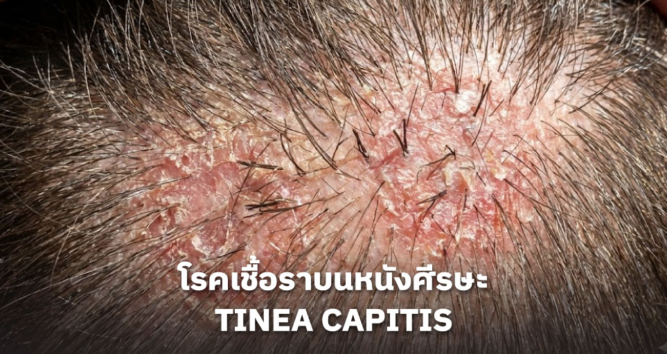 โรคไตเรื้อรัง (Chronic Kidney Disease: CKD) สาเหตุและการรักษา ...